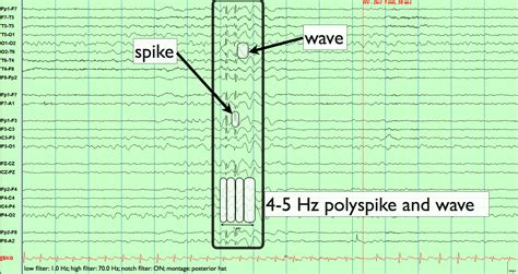 Idiopathic Generalized Epilepsy