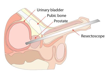 Treatment For Bladder Tumours Transurethral Resection Of Bladder