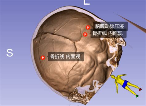 Volume Rendering模块三维渲染术前快速预测继发硬膜外血肿 经验分享 3dslicer中文论坛