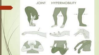 Joint Hyper Mobility Syndrome Pptx