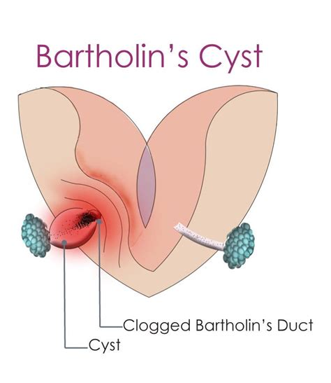 Bartholin Gland Cyst During Pregnancy Bartholin Cyst Causes
