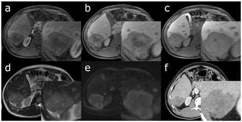 The Diagnostic Approach Towards Combined Hepatocellular Cholangiocarcinoma—state Of The Art And