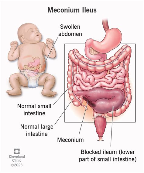 Colonic Ileus Causes Pdf] Intestinal Obstruction In Neonatal Pediatric
