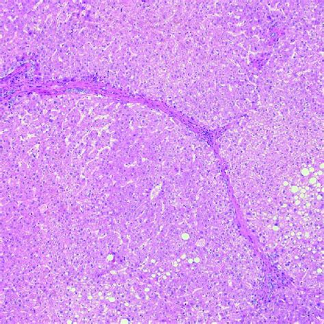 Batts Ludwig Classification System For Staging Fibrosis Download Scientific Diagram