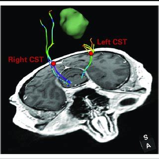 Diffusion Tensor Imaging DTI Tractography Analysis For Mapping White