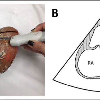 Subxiphoid Equivalent Modified Apical Four Chamber View A The Download Scientific Diagram
