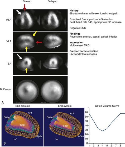 Nuclear Medicine Imaging Of Myocardial Perfusion Radiology Key