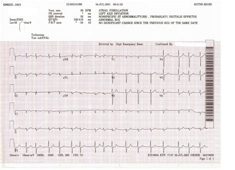 Atrial Fibrillation EKG Examples Wikidoc