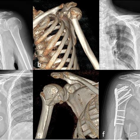 A Radiograph Of A 79 Year Old Woman With Neer Classification Of