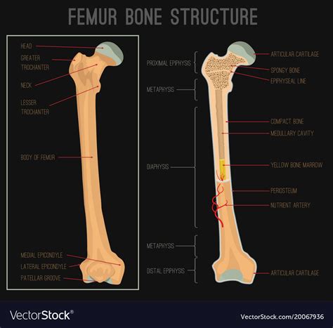 Bone Infarct Femur