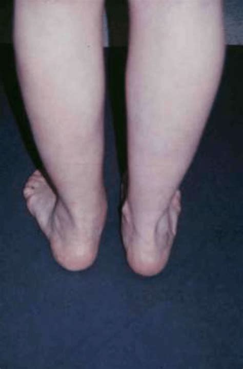 The Too Many Toes Sign Signifying An Abducted Forefoot Is Observed