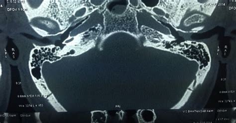 Ent Surgeons Blog Bilateral Thick Tympanic Membranes With Normal Middle Ear