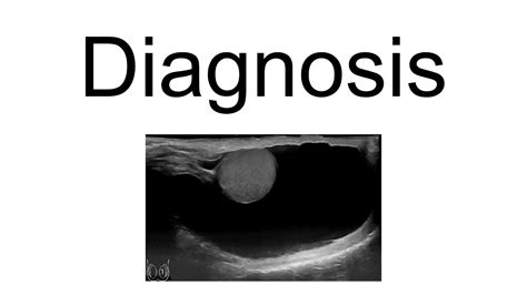 Hydrocele Testis Youtube