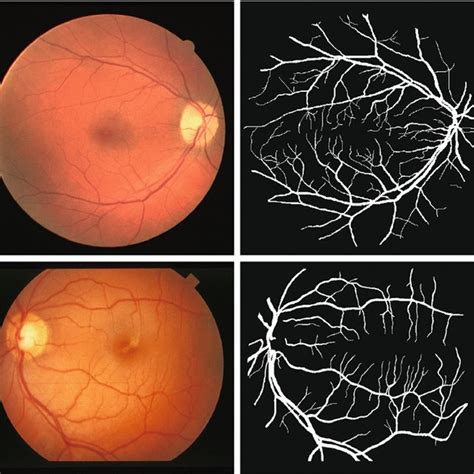 Construction Of Retinal Vessel Segmentation Models Based On Convolutional Neural Network