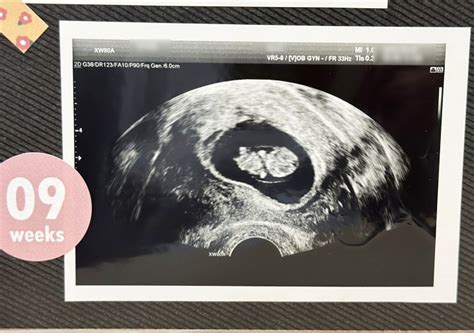 임신 7주차 8주차 9주차 증상 젤리곰초음파 심장소리