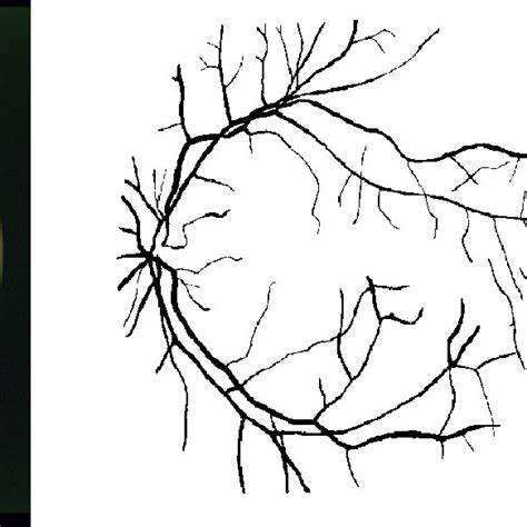 Retinal Vessel Segmentation Using Resnet Unet A Actual Image B Download Scientific Diagram