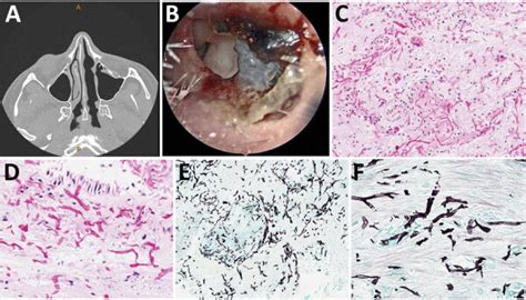 Choanephora Infundibulifera Rhinosinusitis In Man With Acute