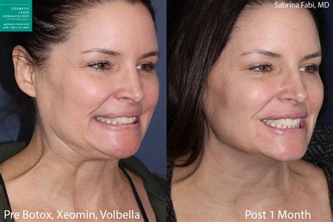Botox For Jaw Clenching Bruxism Cosmetic Laser Dermatology Skin