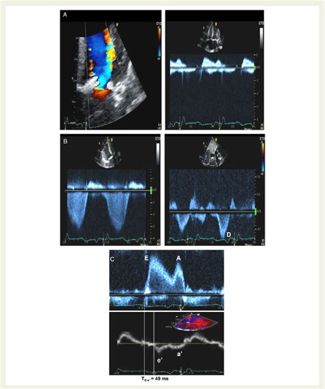 Lv Diastolic Dysfunction Ase IUCN Water