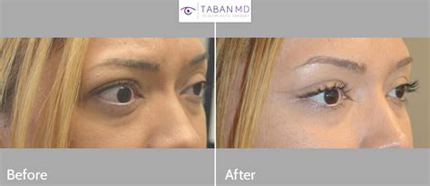 Graves Disease Eyes Bulging