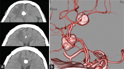 Surgical Neurology International