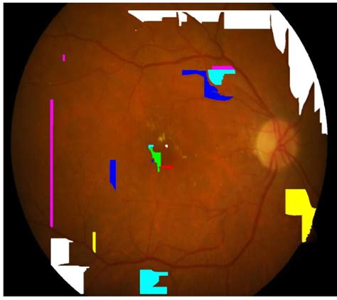 Figure 1 From Automated Microaneurysm Detection In Fundus Images Through Region Growing