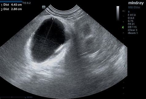 Abdominal Abscessinfarcted Lipoma In A 10 Year Old Mn Beagle Our Case