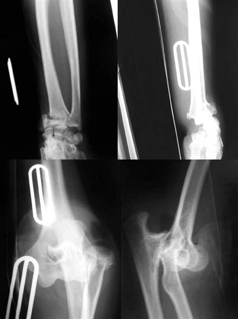 Open Dislocation Of The Elbow With Ipsilateral Fracture Of The Radial Head And Distal Radius A