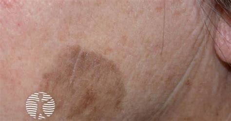 Solar Lentigo Image