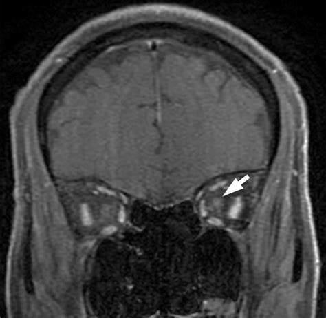 Contrast Enhancement Of The Optic Nerve On Mri Orbital Mri In A