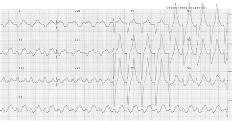 Hyperkalemia Openanesthesia