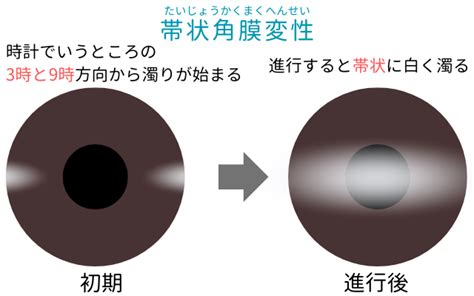 帯状角膜変性 浜松市の高田眼科