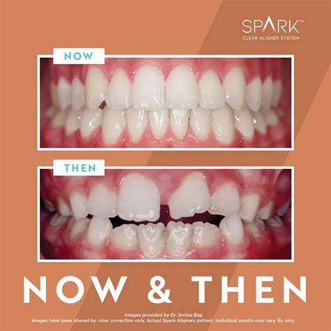 Ormco Orthodontics Orthodontist Sparkaligners Ormco