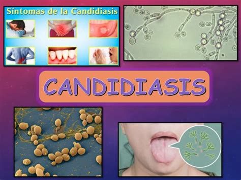 Candidiasis Ppt
