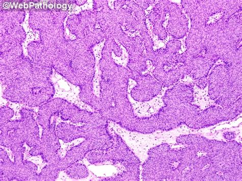 Inverted Urothelial Papilloma Microscopic Features