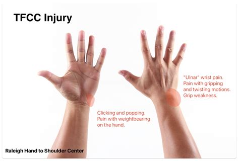 Tfcc Tear In Wrist Raleigh Hand To Shoulder Center