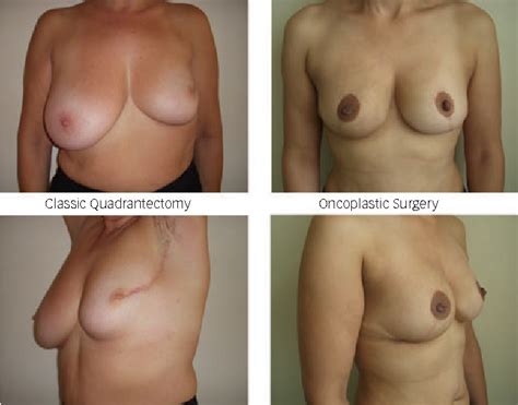 Figure 1 From Oncoplasty As The Standard Of Care In Breast Cancer