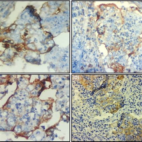 A Colonoscopy Showed A Bulging Polypoid Ulcerative Lesion In The