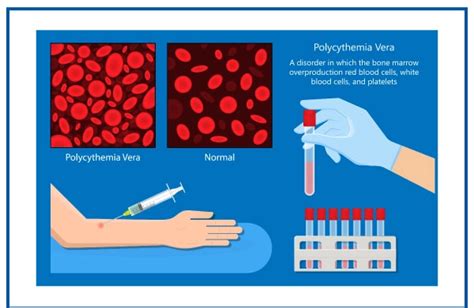 Polycythemia Symptoms Causes Diagnosis Treatment
