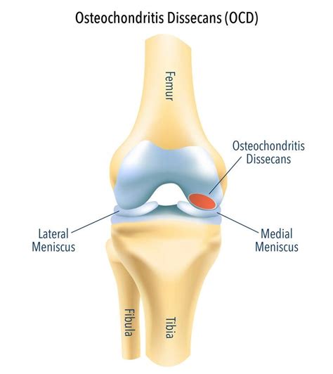 Osteochondritis Dissecans Ocd Lesion