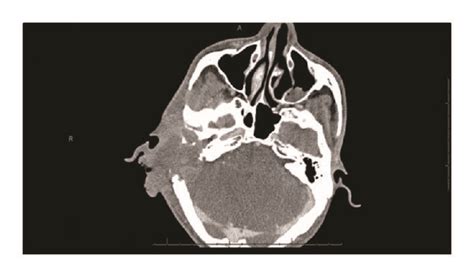 CT Scan Of The Temporal Bone Shows That Compared To Previous Images Download Scientific
