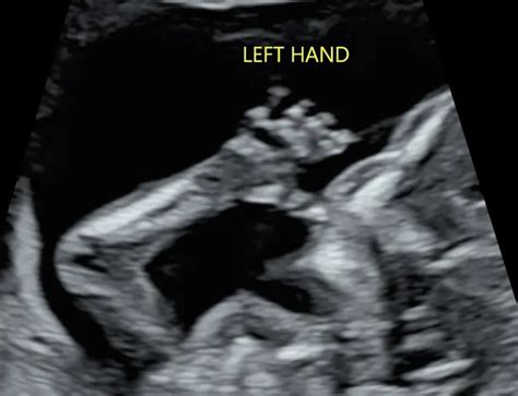 Nuchal Translucency Scan Sydney 12 14 Weeks Cfwu