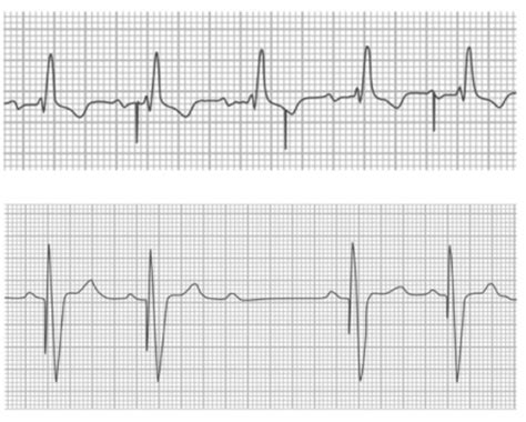 Complications Of Permanent Pacemakers In The