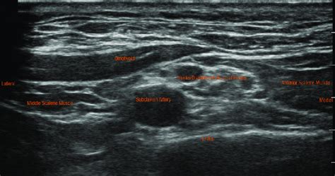 Anomalous Orientation Of The Brachial Plexus At The Level Of The