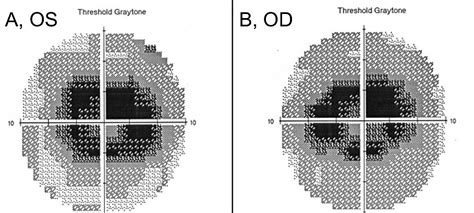 Macular Degeneration Visual Field At Nancy Jensen Blog
