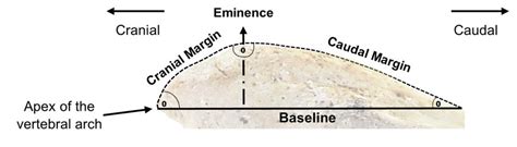 Cervical Spinous Process Presenting Four Morphological Features