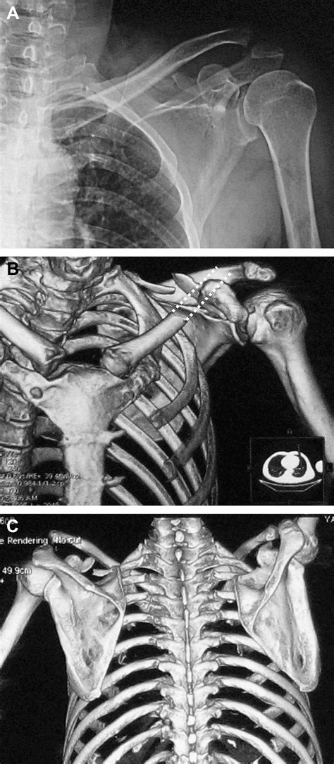 Treatment Of Coracoid Process Fractures Associated With