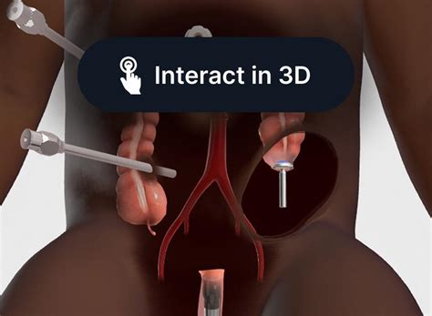 Laparoscopic Sigmoid Colectomy By Nezar Jrebi Md And Jay Redan Md Jandj Medtech