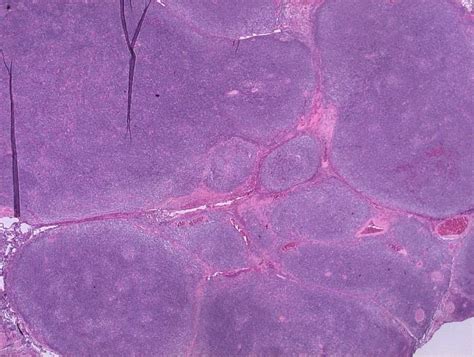 Nodular Infiltrate Of Lymphoma With A Marginal Zone Pattern Of Growth