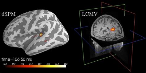 Source Localization Of An Auditory N100 Component Left Results